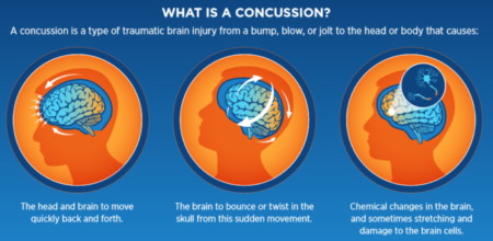 Concussion signs and symptoms, prevention – Mary Donahue